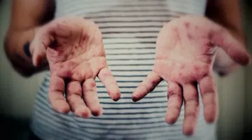 Measles cases confirmed in Buncombe siblings after Spartanburg County ...