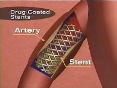 FDA Panel: Benefits of Drug-Coated Stents Outweigh Risks