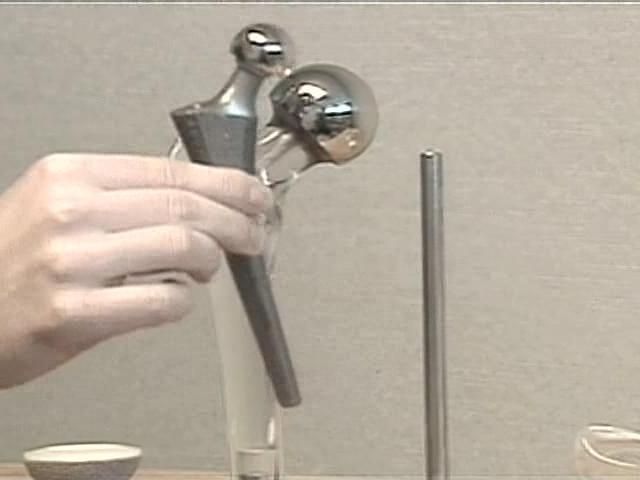 Bone Resurfacing Can Add Life to Joints