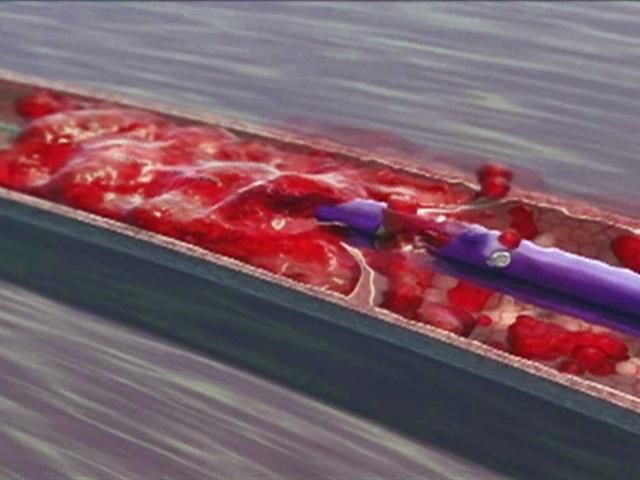 Technique eliminates clots, gets patients on their feet