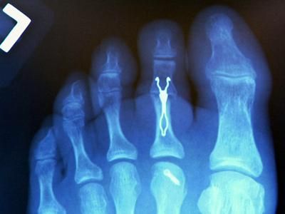 Hammertoes corrected by surgical implants