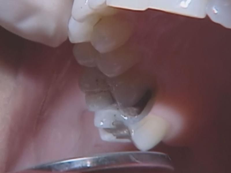 FDA reviews safety of tooth fillings containing mercury