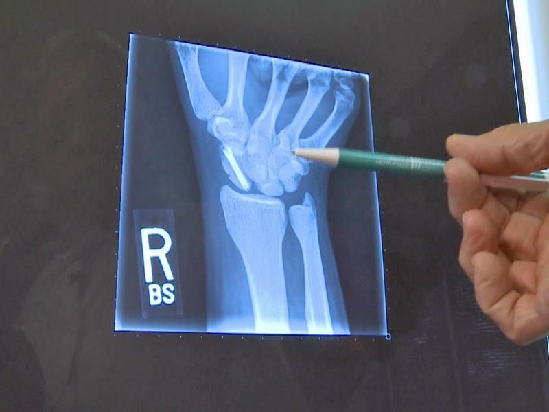 Swift surgery makes UNC point guard's return possible