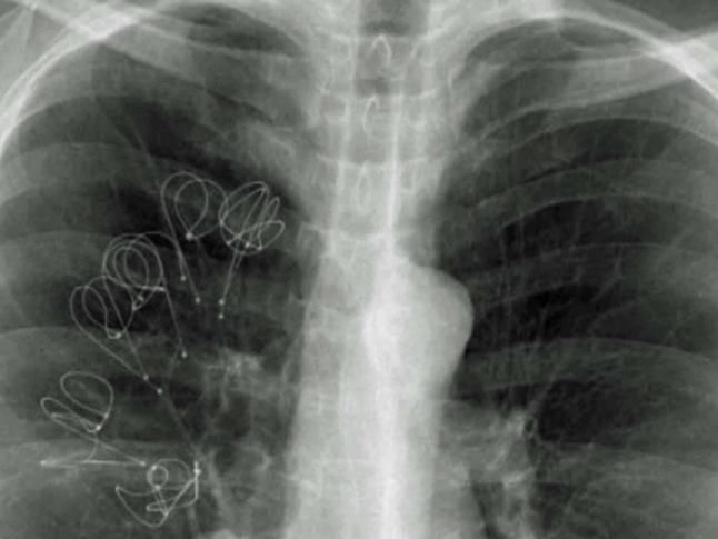 Study: Coils help lung patients breathe easier