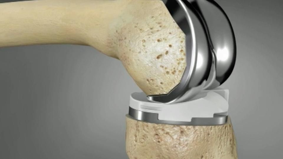 3D technology tailors knee replacement surgeries to individual patients