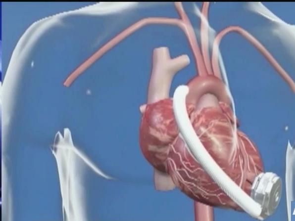 Transplant patient: Don't let the warning signs go by