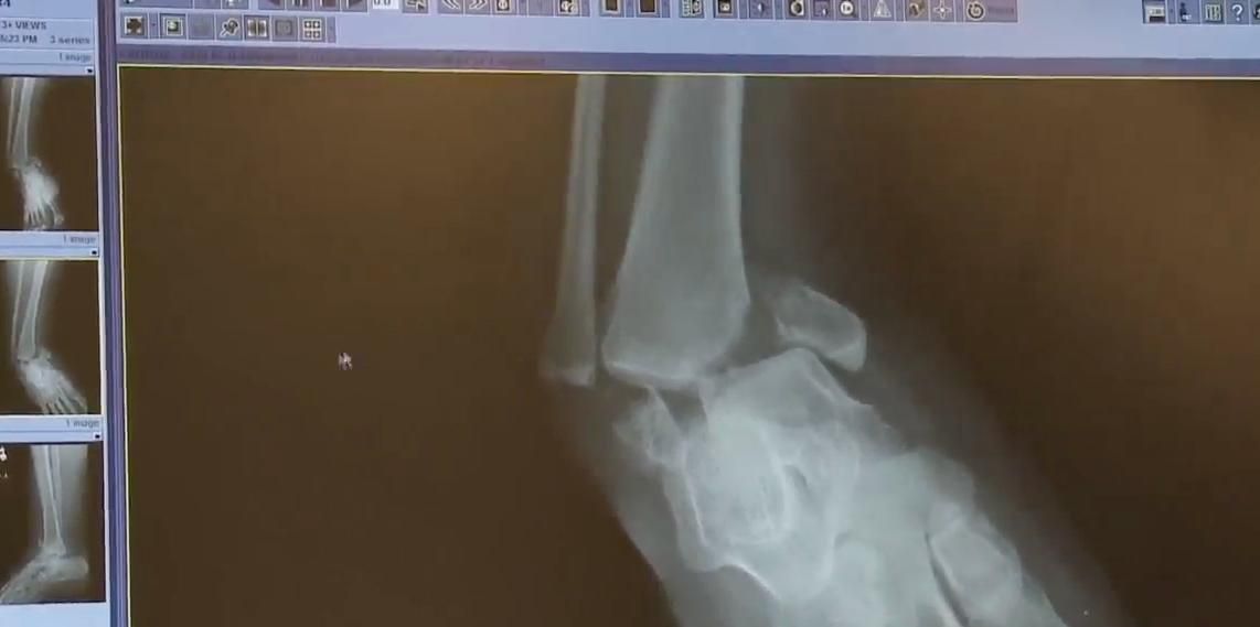 Mask: Look for these signs of fractured bones when kids fall