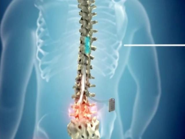 FDA-approved implant offers drug-free relief from chronic back pain