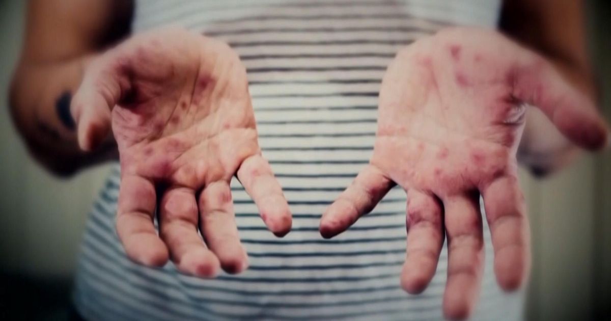 Q&A: What to know about the measles outbreak, and how to protect ...