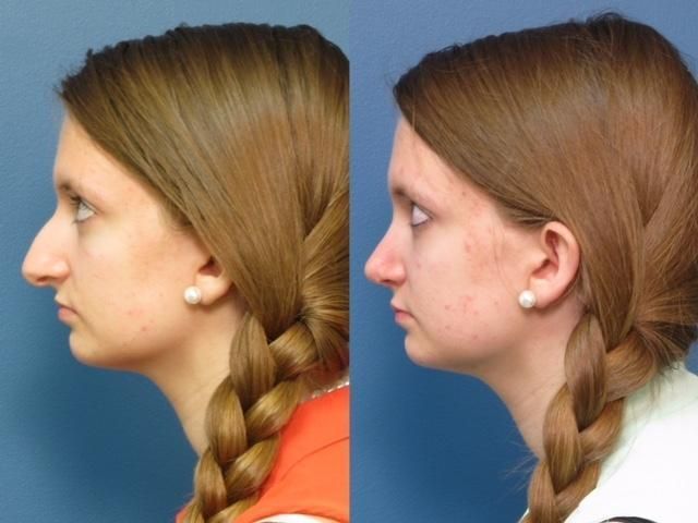 Bullying drives young woman to plastic surgery