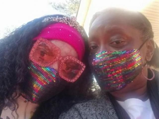 Burn survivor returns home after nearly one year in hospital