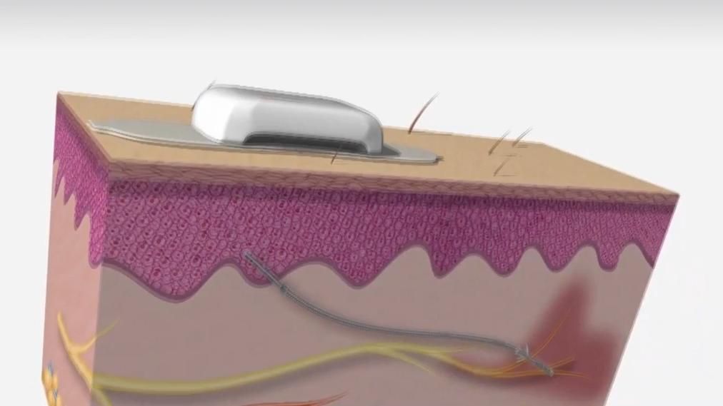 Pain relief implant device helps Durham woman escape 4 years of chronic ...