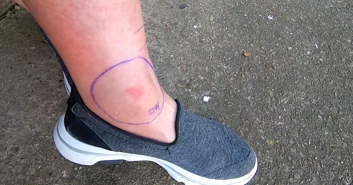 copperhead bite human