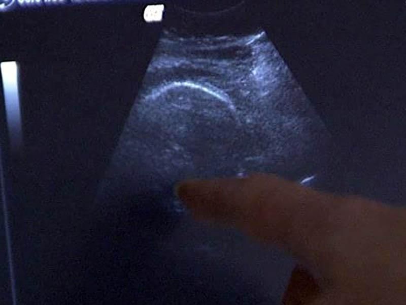 NC ultrasound law requires 'invasive' scan for many