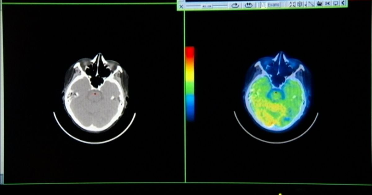 What is glioblastoma? Duke doctor explains the brain cancer after death ...